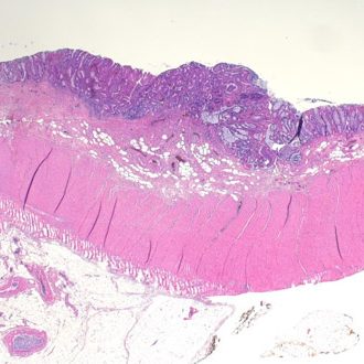 colonic FTRD® - Ovesco Endoscopy AG