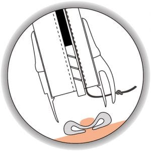 OTSC® System Set - Ovesco Endoscopy AG