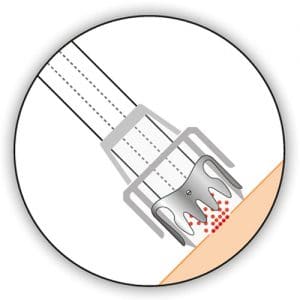 OTSC® System Set - Ovesco Endoscopy AG