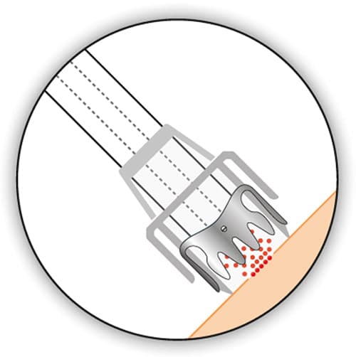 OTSC® System Set - Ovesco Endoscopy AG