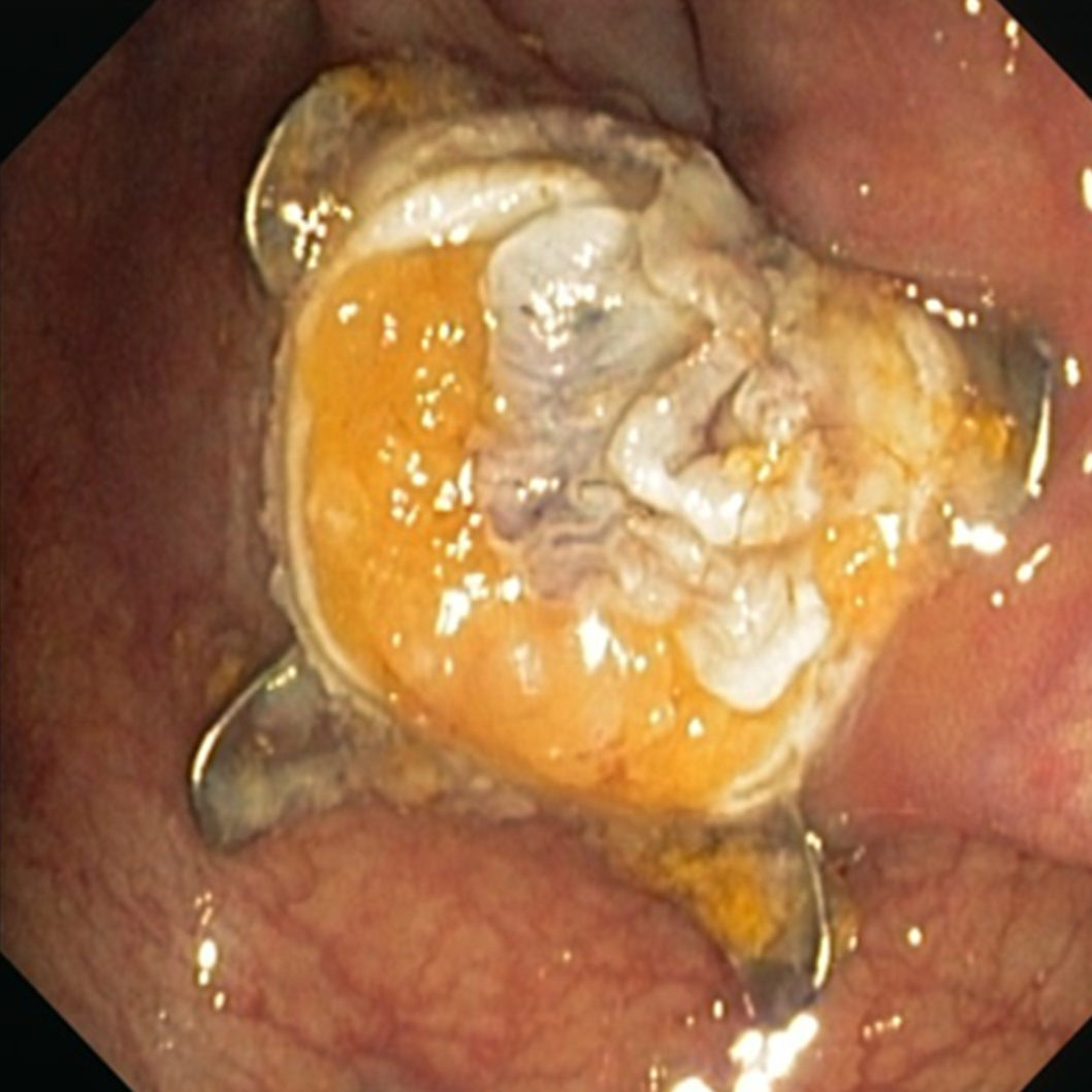 FTRD® Grasper - Ovesco Endoscopy AG