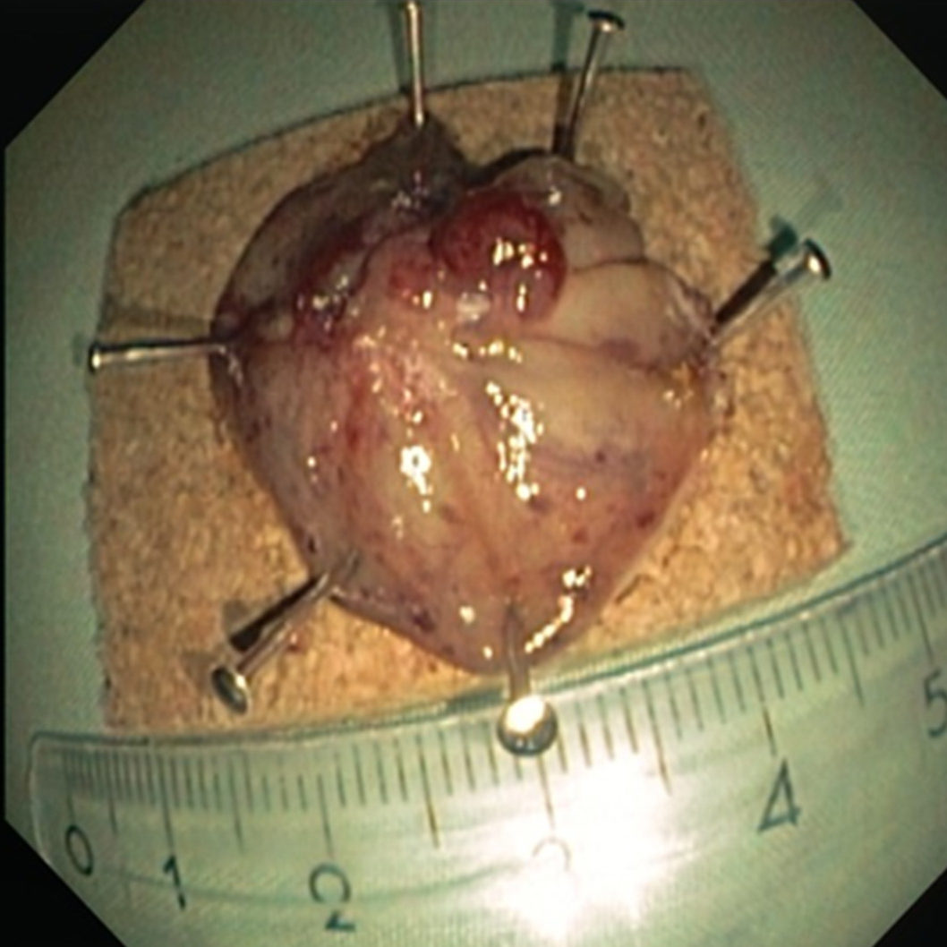 FTRD® Grasper - Ovesco Endoscopy AG