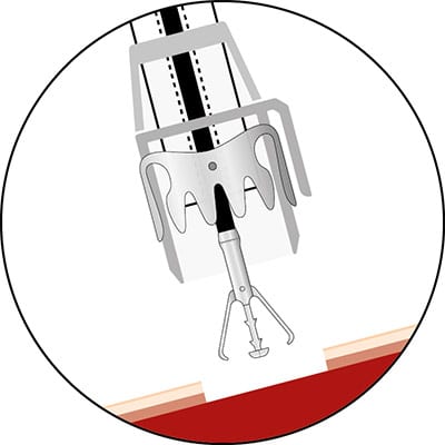 OTSC® System Set - Ovesco Endoscopy AG