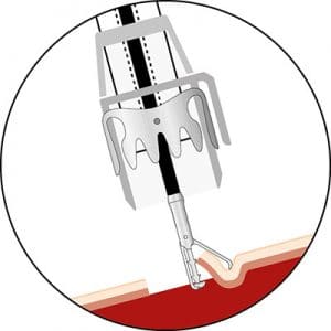 OTSC® System Set - Ovesco Endoscopy AG