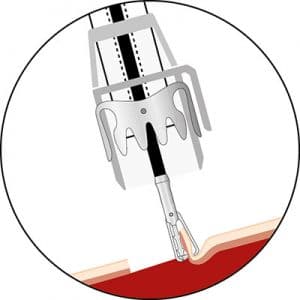 OTSC® System Set - Ovesco Endoscopy AG