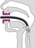 gastroduodenal FTRD® - Ovesco Endoscopy AG