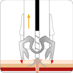 OTSC® System Set - Ovesco Endoscopy AG