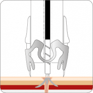 OTSC® System Set - Ovesco Endoscopy AG