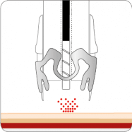 OTSC® System Set - Ovesco Endoscopy AG