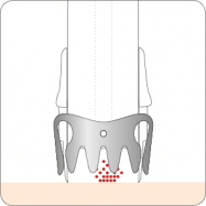 OTSC® System Set - Ovesco Endoscopy AG