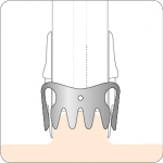 OTSC® System Set - Ovesco Endoscopy AG