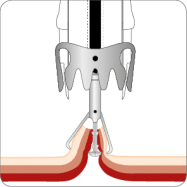 OTSC® System Set - Ovesco Endoscopy AG