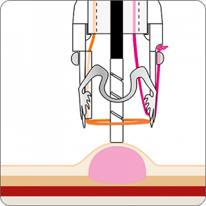 gastroduodenal FTRD® - Ovesco Endoscopy AG