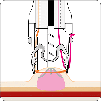 gastroduodenal FTRD® - Ovesco Endoscopy AG